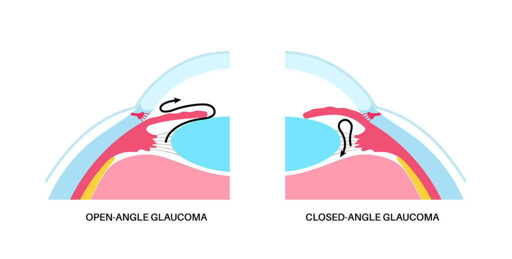 Narrow angles and Acute Angle Closure Glaucoma – Booragoon Eye Clinic