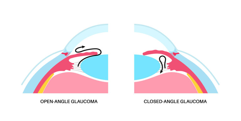 Narrow angles and Acute Angle Closure Glaucoma – Booragoon Eye Clinic